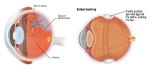 Scleral Buckle Treatment Bronx NY - Retinal Reattachment NY